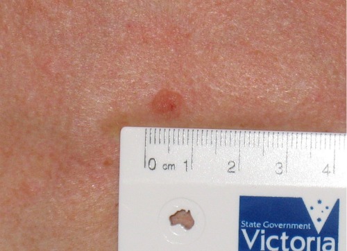 Ron Guba on essential oils and skin cancer - Robert Tisserand